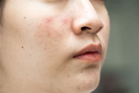 Facial Rashes Causes Symptoms And Treatment Options Assurance Skin