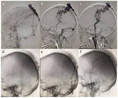 Intravascular Embolization Versus Surgical Resection For Patients With Scalp Arteriovenous
