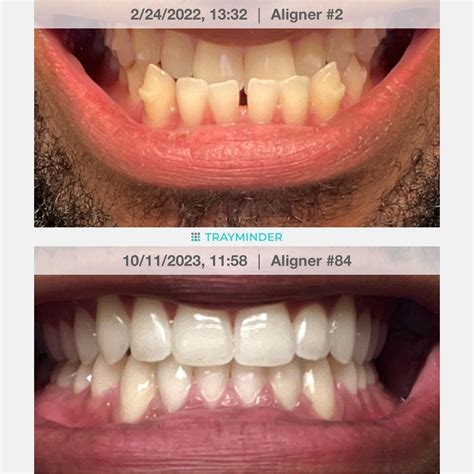 Finished 36 Trays And 15 Refinement Trays R Invisalign