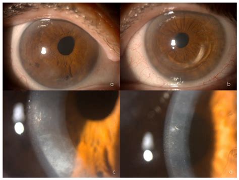 Posterior Polymorphous Corneal Dystrophy In A Patient With A Novel Zeb1