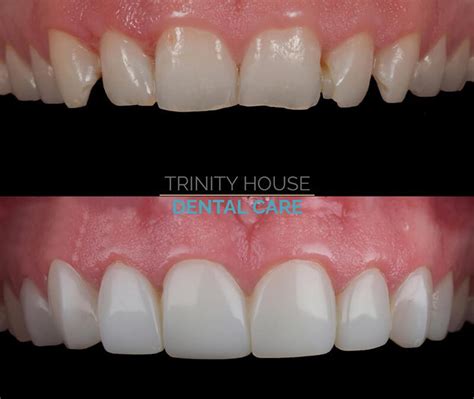Composite Bonding After Braces The Secret Weapon For A Perfect Finish Trinity House