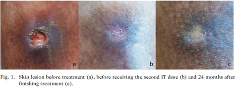 Immunological Correlates Of Cure In The First American Cutaneous Leishmaniasis Patient Treated