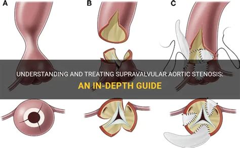 Understanding And Treating Supravalvular Aortic Stenosis An In Depth Guide Medshun