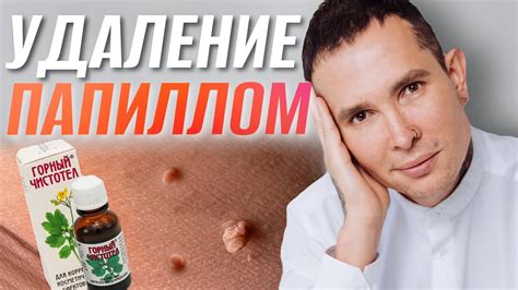 Удаление бородавок в домашних условиях с помощью уксуса и коланхоэ