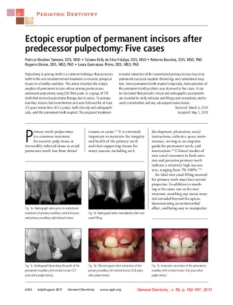 Pdf Ectopic Eruption Of Permanent Incisors After Predecessor