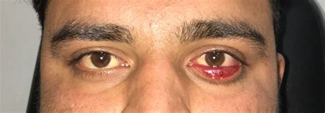 Watering And Tearing Eyes Dr Saurbhi Khurana Gurugram