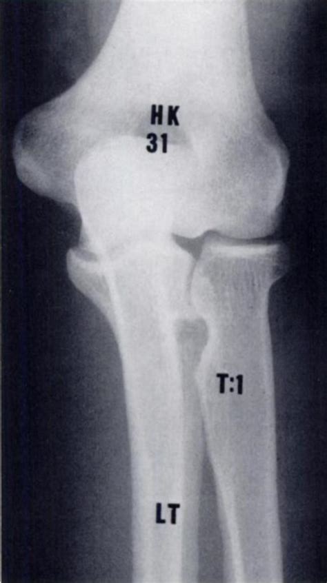 Congenital Radial Ulnar Synostosis Hand Orthobullets