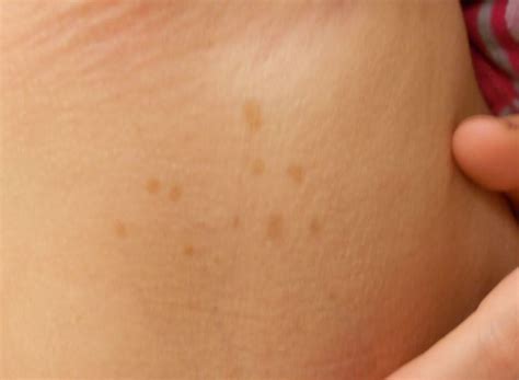 Clinical Challenge Hyperpigmented Axillary Macules Mpr