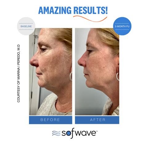 Sofwave Skin Lifting And Tightening