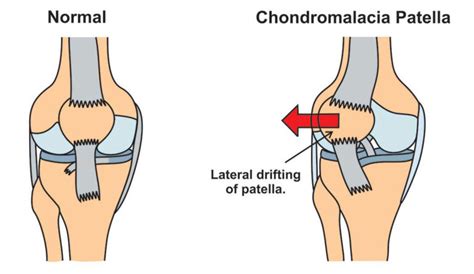 Causes Of Chondromalacia And Knee Pain Best Treatment Physio2health