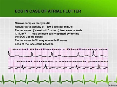 Atrial Flutter Vs Afib Hourhac