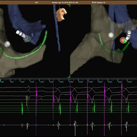 Representative Electroanatomical Map During Ablation Of Left Sided Ap Download Scientific