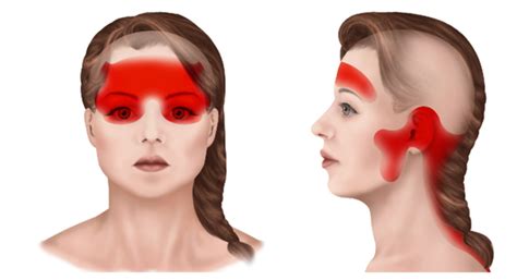 Tension Headache Dr Piyush Kumar Anshu