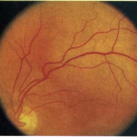 Left Fundus At Presentation Showing Pale Choroidal Mass With