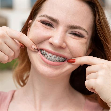 Brackets Metálicos ¿que Son ClÍnica Dental Onsmile