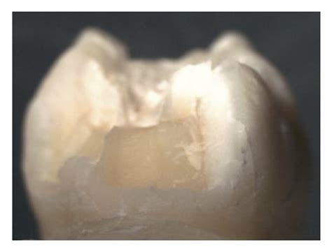 Fracture Modes A Type 1 B Type Ii C Type Iii D Type Iv Download Scientific Diagram