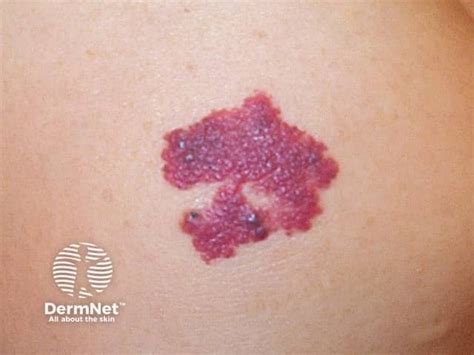 Lymphatic Malformation Lymphangioma Cystic Hygroma Lymphangioma