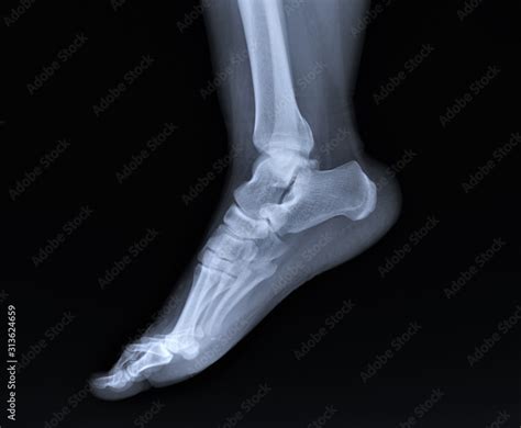 Radiograph Of The Ankle Joint With A Fracture Of The Outer Ankle Without Displacement