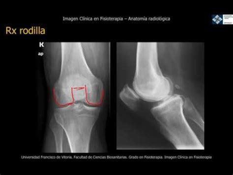 Anatomía Rx Rodilla Youtube