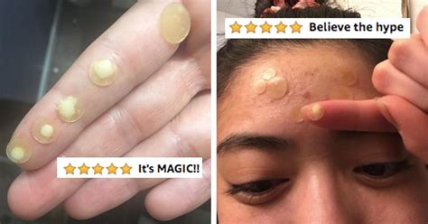 Before And After Pimple Patches Uk Pre Brunofuga Adv Br