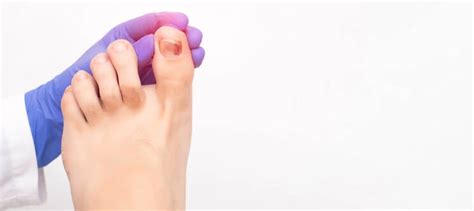 Chilblains Symptoms Diagnosis And Treatment 24 7medcare