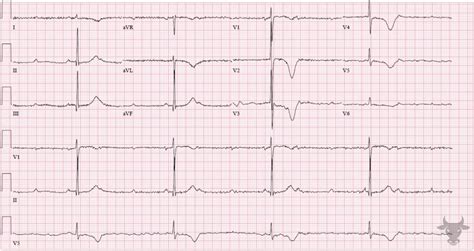Second Degree Atrioventricular Block Mobitz Ii Ecg Stampede