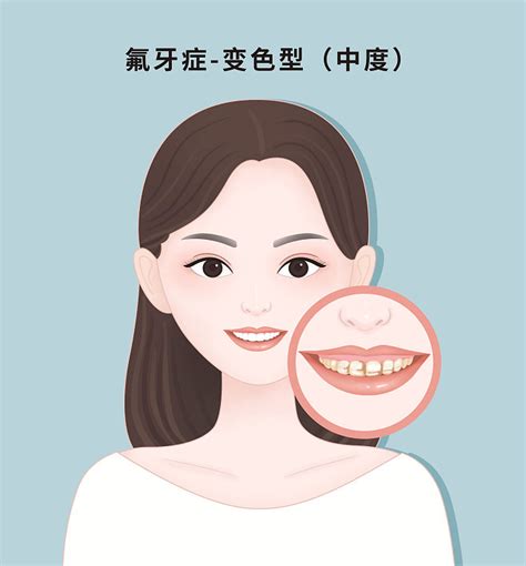 氟牙症 美白牙贴面 牙齿美白 牙齿矫正 牙齿疾病 牙齿问题 牙齿贴面 色素牙 黄牙 黑牙 斑点牙 超声波洗牙 牙部综合 智齿发炎 根尖周炎