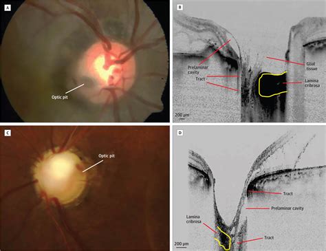 Optic Disc Maculopathy At Levi Skipper Blog