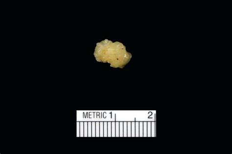 Pathology Outlines Papillary Fibroelastoma