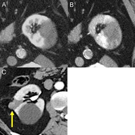 Single Bolus 2 Phase Ct Urography Ctu A B And Split Bolus 1 Phase Download Scientific