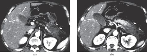 Comparison Of The Clinical Characteristics And Imaging Findings Of Acute Cholangitis With And