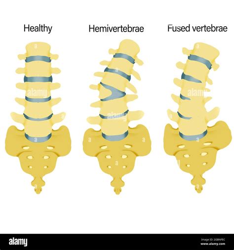 What Is Spine Deformity At Philip Ayala Blog