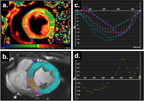 Cmr As A Non Invasive Tool For Assessing Regional Tissue Systolic And