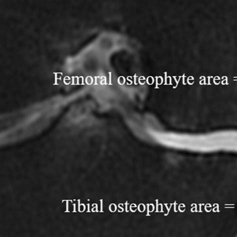 With The Medial Collateral Ligaments Visible Find The Layer Where The