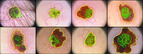 Segmentation Of Dermoscopy Images Using Manual Annotations White