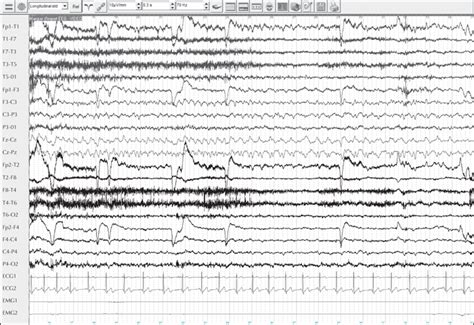 JLE Epileptic Disorders Adult Onset Rasmussen Encephalitis Associated With Focal Cortical