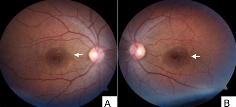 Alport Syndrome With Bilateral Simultaneous Anterior And Posterior