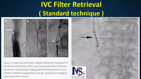 Ivc Filter Pdf