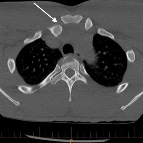 Ct Scan Showing Recurrence Of Posterior Sc Joint Dislocation Download Scientific Diagram