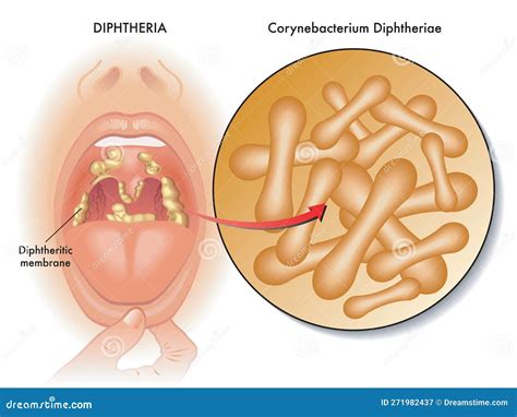 Corynebacterium Diphtheriae Infection Stock Vector Illustration Of Paralysis Inflammation