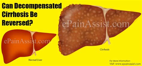 Can Decompensated Cirrhosis Be Reversed