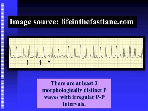 Narrowcomplextachycardiapptx