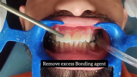 Orthodontic Bonding Procedure Youtube