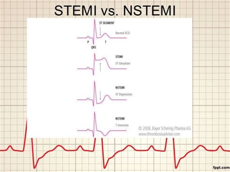 As 25 melhores ideias de Stemi vs nstemi no Pinterest Ems Fisioterapia respiratória e Nclex