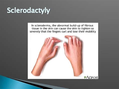 Systemic Lupus Erythematous And Scleroderma Crest Syndrome Arodis