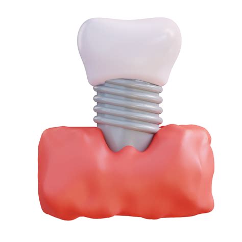 3d Illustration Of Fitting Dentures 21017711 Png
