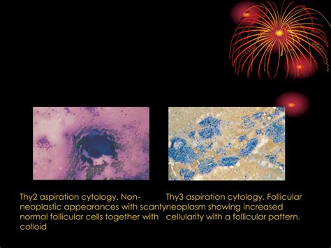 Ppt Solitary Nodule Of Thyroid Powerpoint Presentation Free Download