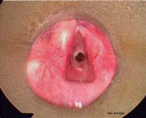 Stenosi Laringea Benigna Delladulto Maurizio G Vigili