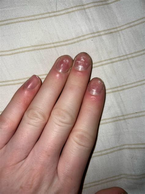 White Spots On Fingernails Raskdoctorsmeeee