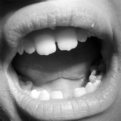 Thick And Brittle Nails Key Features Of An Ectorderm Dysplasia Patient Download Scientific